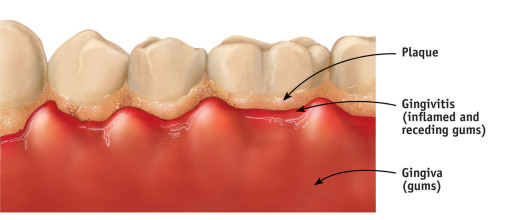 Things You Need to Know AboutPlaque